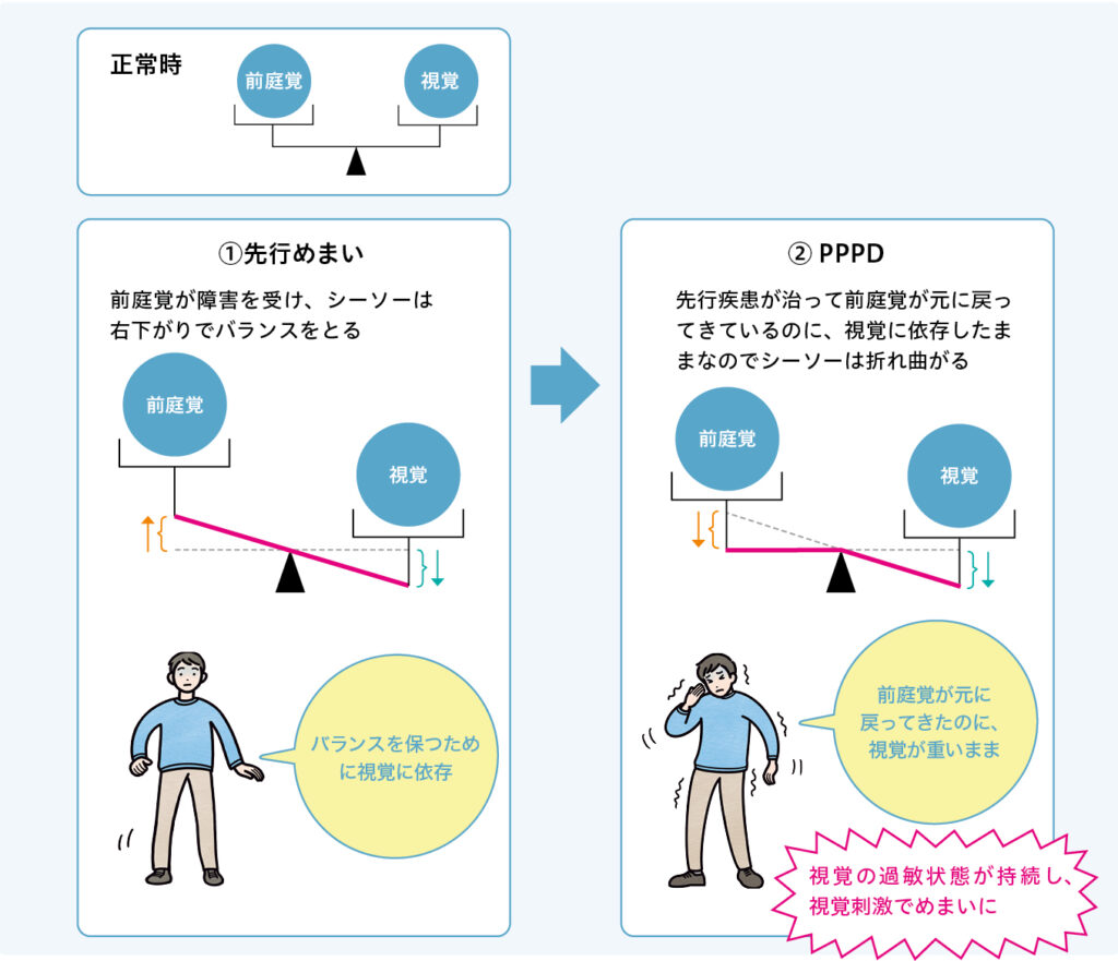 PPPD（持続性知覚性姿勢誘発めまい）の症状・原因は？ | エキスパートナースweb