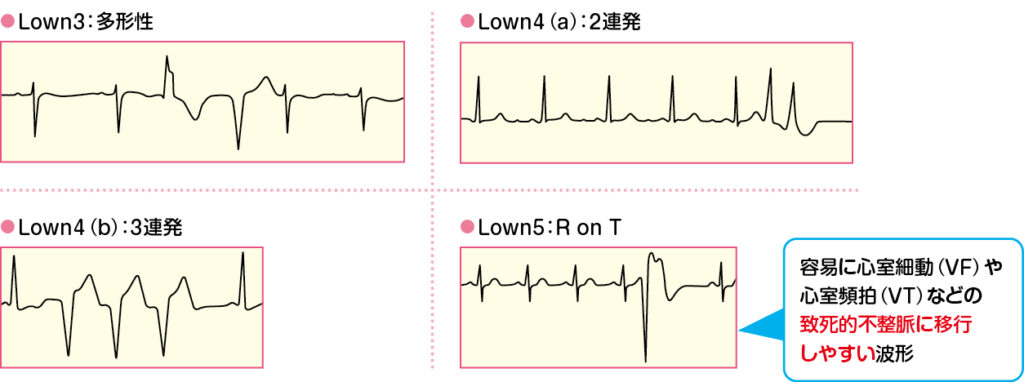 【図解付き】心室期外収縮（PVC/VPC）の心電図波形の特徴は？読み方の要点を解説 | エキスパートナースweb