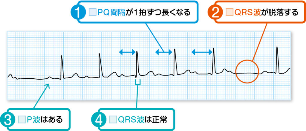 Ⅱ度房室ブロック（Ⅱ°AVB）の心電図波形の読み方【図解付き】 | エキスパートナースweb