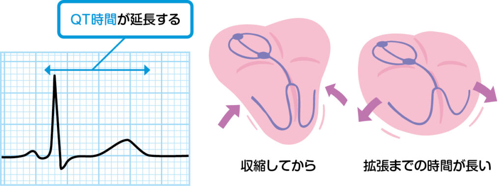 QT延長症候群の心電図波形の読み方 | エキスパートナースweb