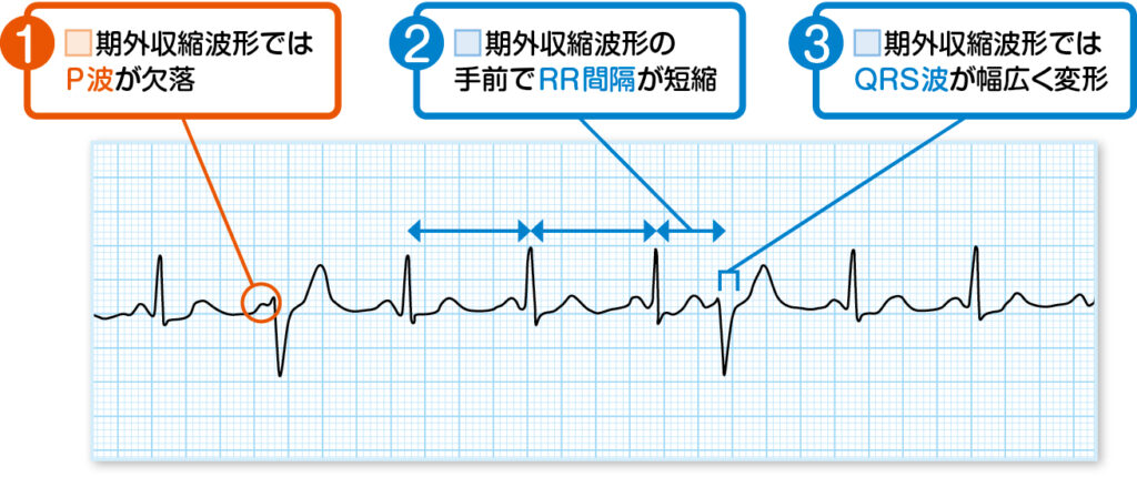 【図解付き】心室期外収縮（PVC/VPC）の心電図波形の特徴は？読み方の要点を解説 | エキスパートナースweb